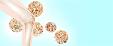 Natural Approaches To Osteoporosis Treatment Makebrightdaycom