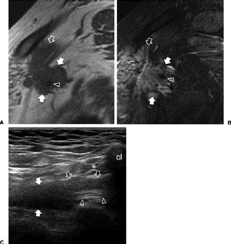 Brachial Plexus Metastasis From Breast Cancer In A 65 Year Old Woman Download Scientific