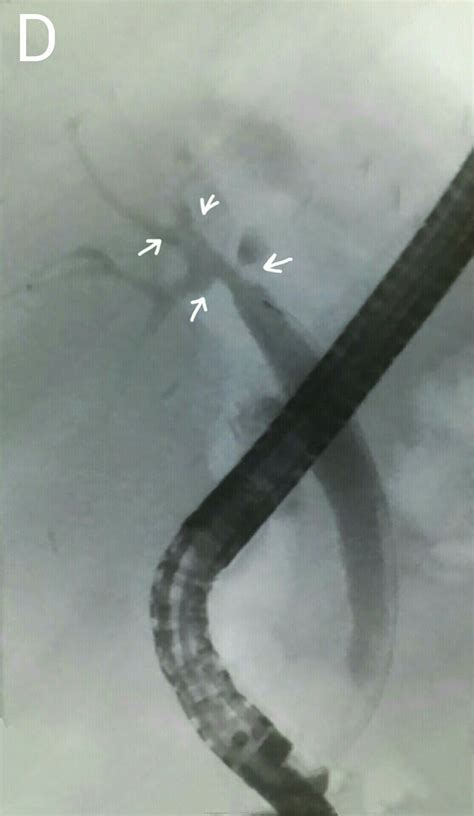 Ercp And Egd Third Follow Up Ercp For Post Transplant Anastomotic