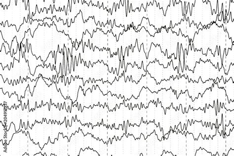 Abnormal Eeg