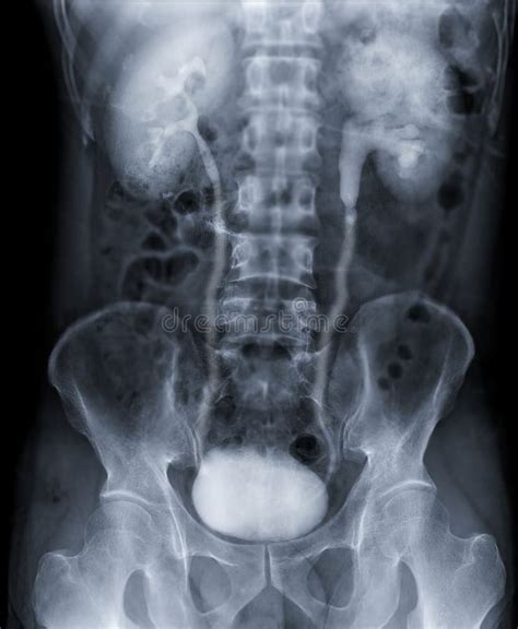 Intravenous Pyelogram Or Ivp Stock Image Image Of Renal Bladder 281853613 Intravenous Pyelogram Or Ivp Stock Image Image Of Renal Bladder 281853613