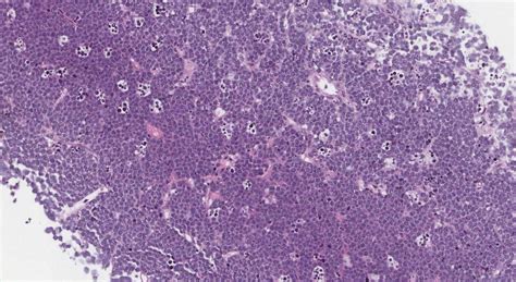 Burkitt Lymphoma Ottawa Atlas Of Pathology
