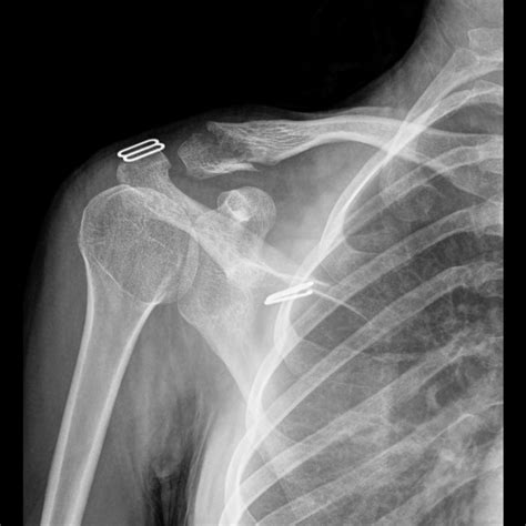 Distal Clavicle Fracture Classification