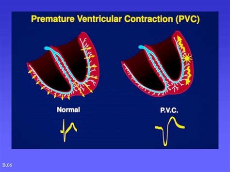 Bsi 2 Lec 22 23 Ekg Interpretation Flashcards Quizlet