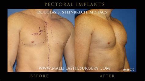 Pectoral Implants Male Plastic Surgery Chicago