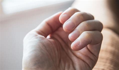 ‘reddish Brown Lines Underneath The Nails Could Signal Endocarditis