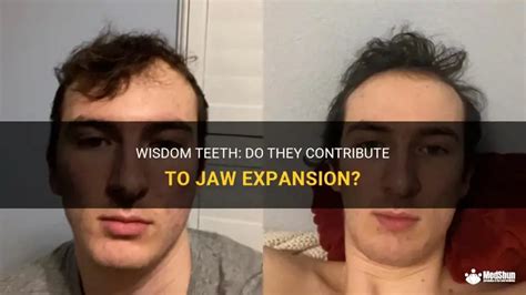Wisdom Teeth Do They Contribute To Jaw Expansion Medshun