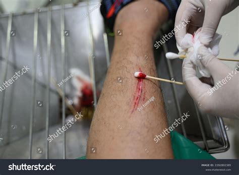 Bleeding Cut On Leg