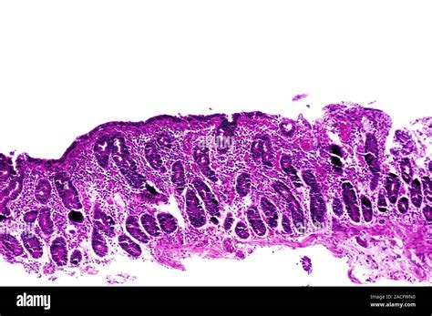 Coeliac Disease Light Micrograph Of A Section Through A Jejunum Affected By Coeliac Disease