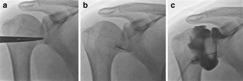 Glenohumeral Shoulder Injection Under Fluoroscopic Guidance