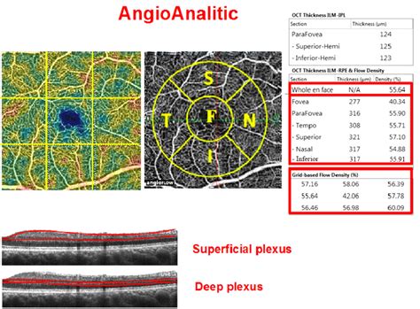 Macular Vascular Density Protocol Angiovue Retina Protocol Rtvue Xr