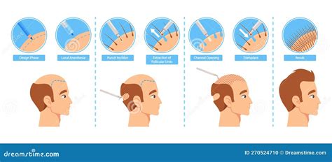 A Step By Step Infographic To Hair Transplantation Procedure Design