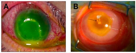 Figure 1 From An Eye On Staphylococcus Aureus Toxins Roles In Ocular