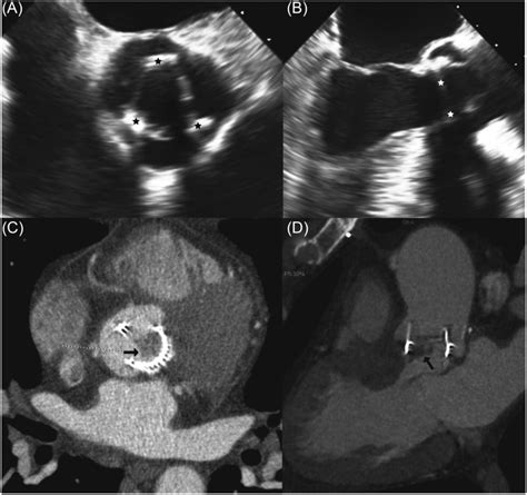 A Short Axis And Long Axis B Transesophageal Echocardiogram Views Of Download Scientific