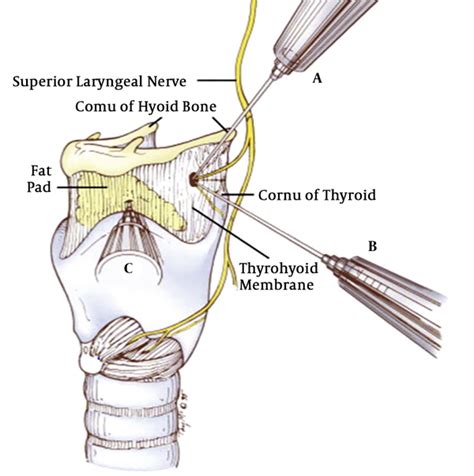 Glossopharyngeal Nerve Block