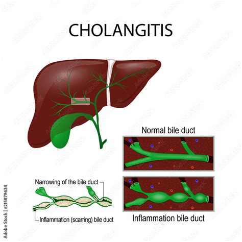 Cholangitis Cross Section Of The Human Liver Bile Duct And