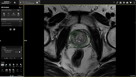 Mr Prostate Ai Based Segmentation And Classification