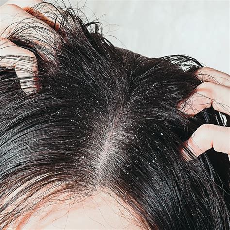 Common Scalp Problems Dr Wang Yi Shi W Skin And Laser Clinic