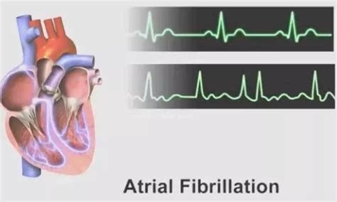 Mainstay Ablation Procedure For Atrial Fibrillation Shows Substantial