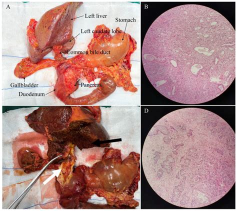 Laparoscopic Hepatopancreatoduodenectomy For Synchronous Intrahepatic