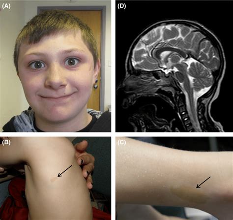 Microcephaly Small Head Syndrome