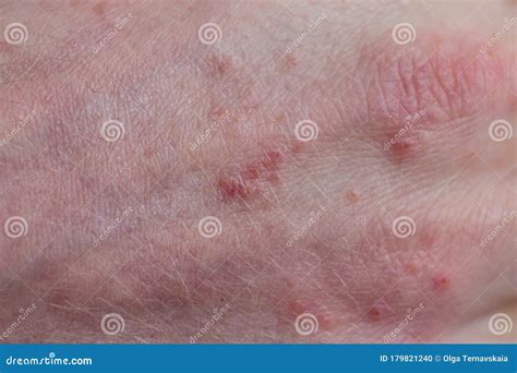 Close Up Of A Patients Fingers Showing Plaques Of Dry Skin Typically