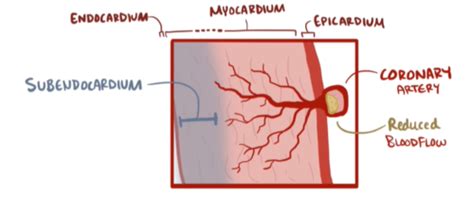 Coronary Artery Disease Cad Flashcards Quizlet