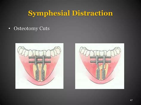 Distraction Osteogenesis Pptx
