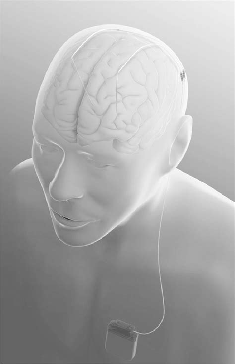 Connection Of DBS Electrode And Implantable Pulse Generator Reprinted Download Scientific