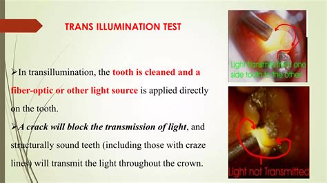 Vertical Root Fracture Pdf