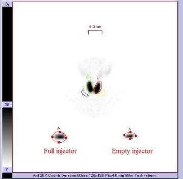 Calculation Of Thyroid Uptake A Calculation Of Uptake In A Patient Download Scientific