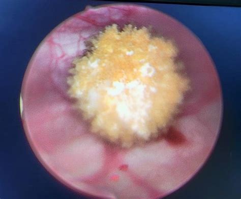 How Long Does It Take To Recover From Bladder Stone Surgery Quora