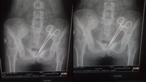 Sikkim Woman Found With Surgical Scissors In Abdomen 12 Years After