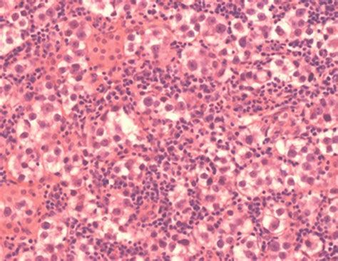 Testicular Cancer Management Of Stage I Seminoma Urology News