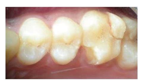 Oblique Fracture Of Distofacial Cusp With 16 With Loss Of Mesiopalatal Download Scientific