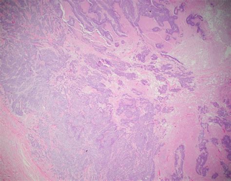 Pathology Outlines Invasive Breast Cancer Of No Special Type Nst