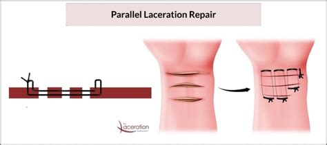 Repairing Parallel Lacerations In The Urgent Care Center Journal Of