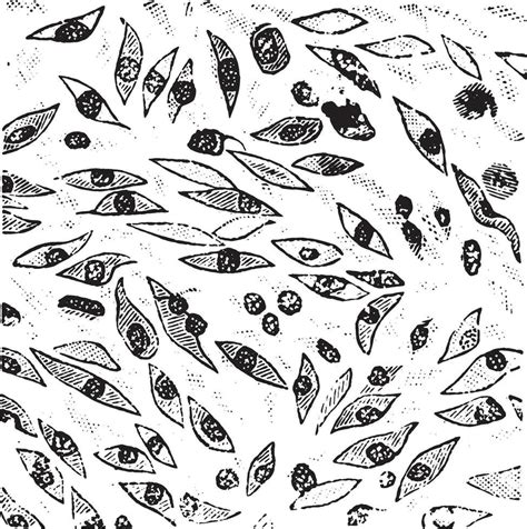 Spindle Cell Sarcoma Vintage Engraving 35466399 Vector Art At Vecteezy