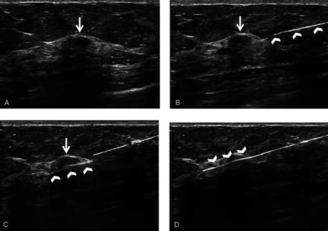 Ultrasound‐guided Breast Biopsies Basic And New Techniques Pmc