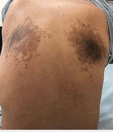 Well Defined Bilateral Hyperpigmentation With Irregular Borders On The Download Scientific