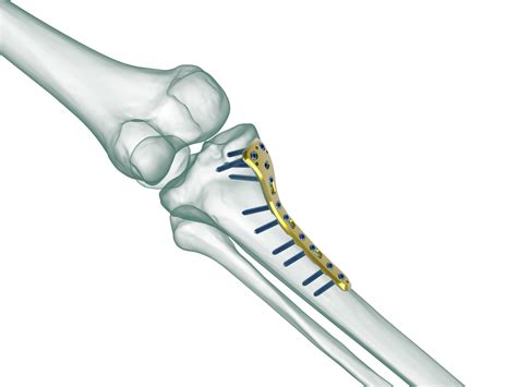 Proximal Tibia Posteromedial Locking Plate TRUEMED Medikal