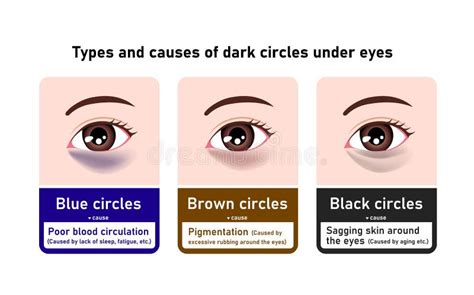 Types And Causes Of Dark Circles Under Eyes Vector Illustration Stock