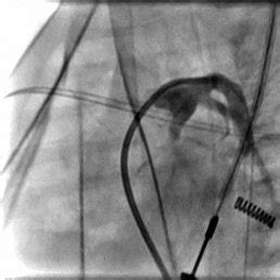 A Krichenko Type C PDA In A Premature Infant Is Shown A Typical PDA Download Scientific