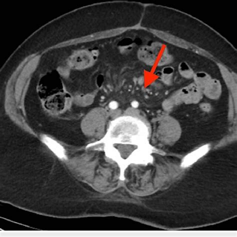 Ct Abdomen And Pelvis With Sub Centimeter Lymph Nodes And Surrounding