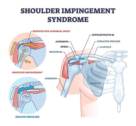 Impingement Syndrome Physioflow Pt Physical Therapy Vancouver Wa
