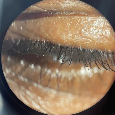 Demodex Blepharitis Xdemvy® Lotilaner Ophthalmic Solution 0 25