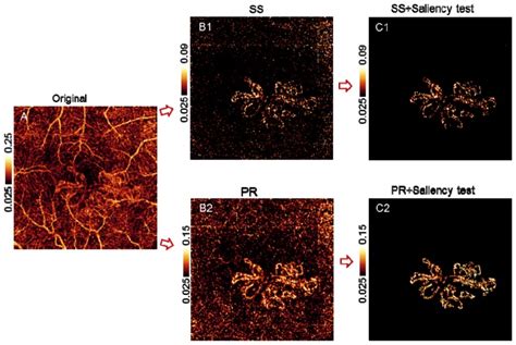 Projection Resolved Optical Coherence Tomographic Angiography Pmc