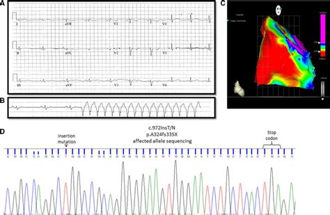 Modeling Of Arrhythmogenic Right Ventricular Cardiomyopathy With Human Induced Pluripotent Stem