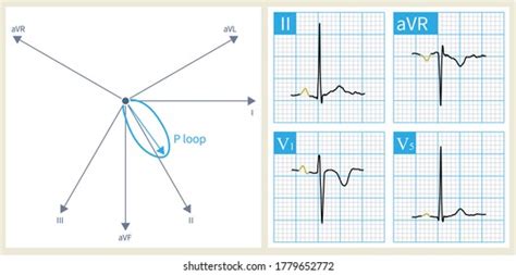 P Wave Biphasic Images Stock Photos Vectors Shutterstock