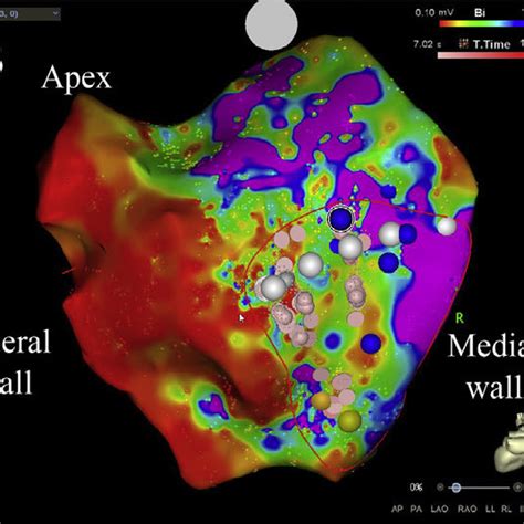 3 Dimensional Electroanatomic Map Showing The Ablation Sites Download Scientific Diagram